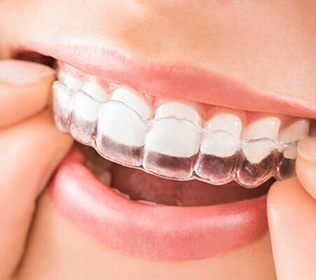 Invisible Aligners - Jindal Dental Care Hospital